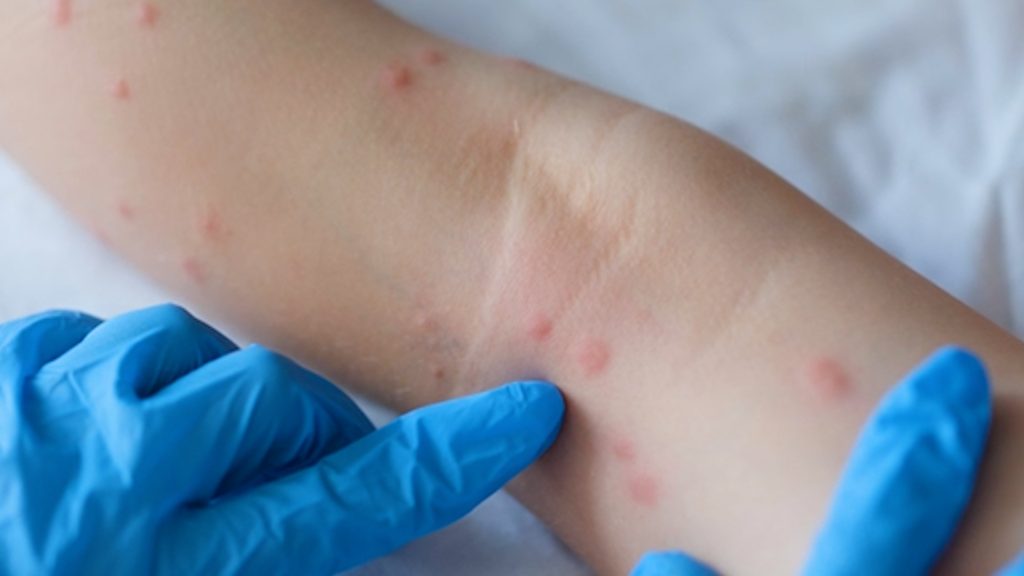 Smallpox Mystery Finally Solved - Vida Newspaper